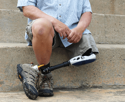 The Value of Amputation Compensation | Hodge Jones & Allen